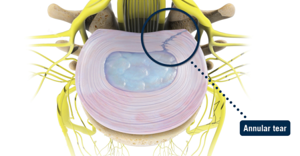 Annular Tear - Causes, Symptoms & Treatment | Bonati Spine Institute