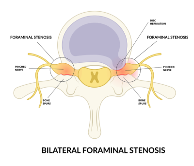 Bilateral Foraminal Stenosis | Bonati Spine Institute